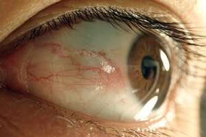 Le ptérygion: Le traitement chirurgical est la seule option