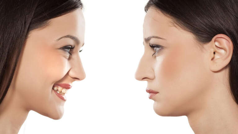 Injection nez avant apres pour une rhinoplastie sans chirurgie