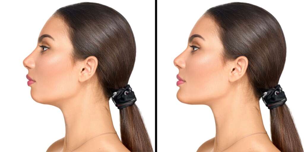 Menton fuyant, quelle solution pour la corriger